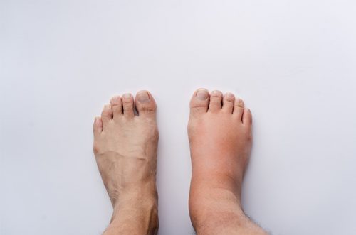 Telapak Kaki Bengkak Dan Sakit - Perumperindo.co.id